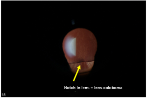 Uveal Coloboma – Portland Eye Care | Optometrist | Eyeglasses | Contact ...